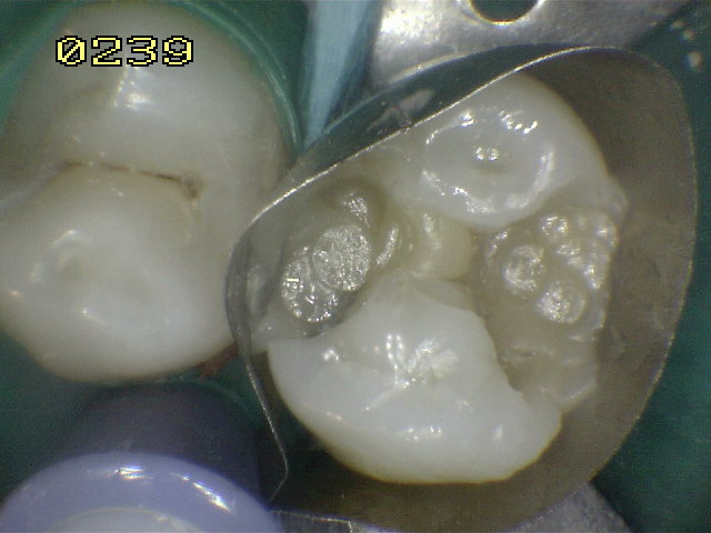 Casos clínicos: Clase I, II, III y IV