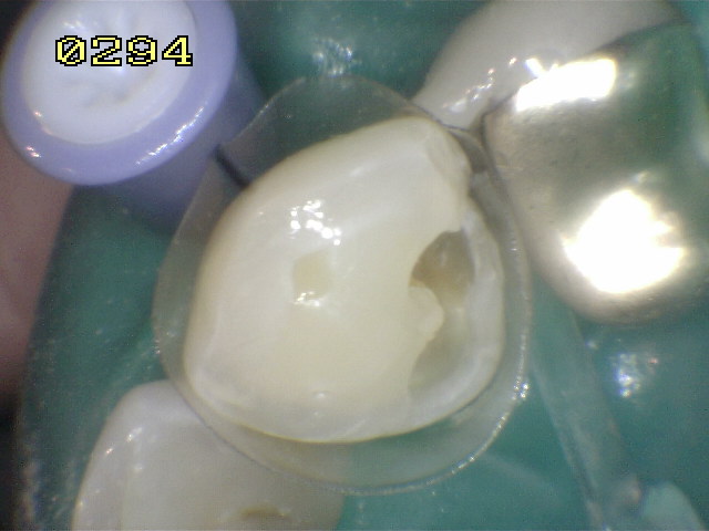 Grabado ácido del esmalte dental