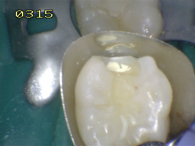 Grabado ácido del esmalte dental