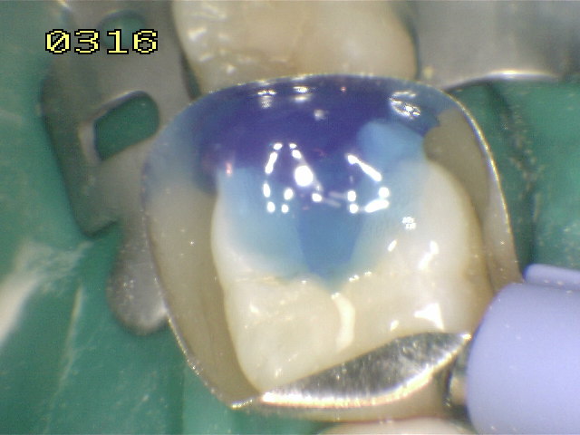 Grabado ácido del esmalte dental